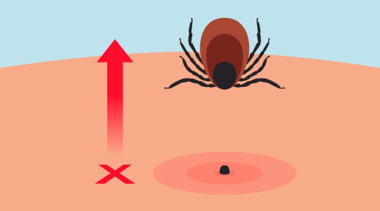 Comment retirer une tique? • piqure-de-tique.ch